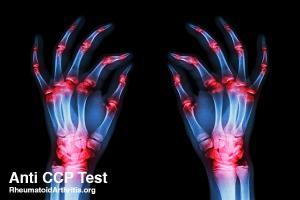 RA and Anti-CCP: What is the Purpose of an Anti-CCP Test ...